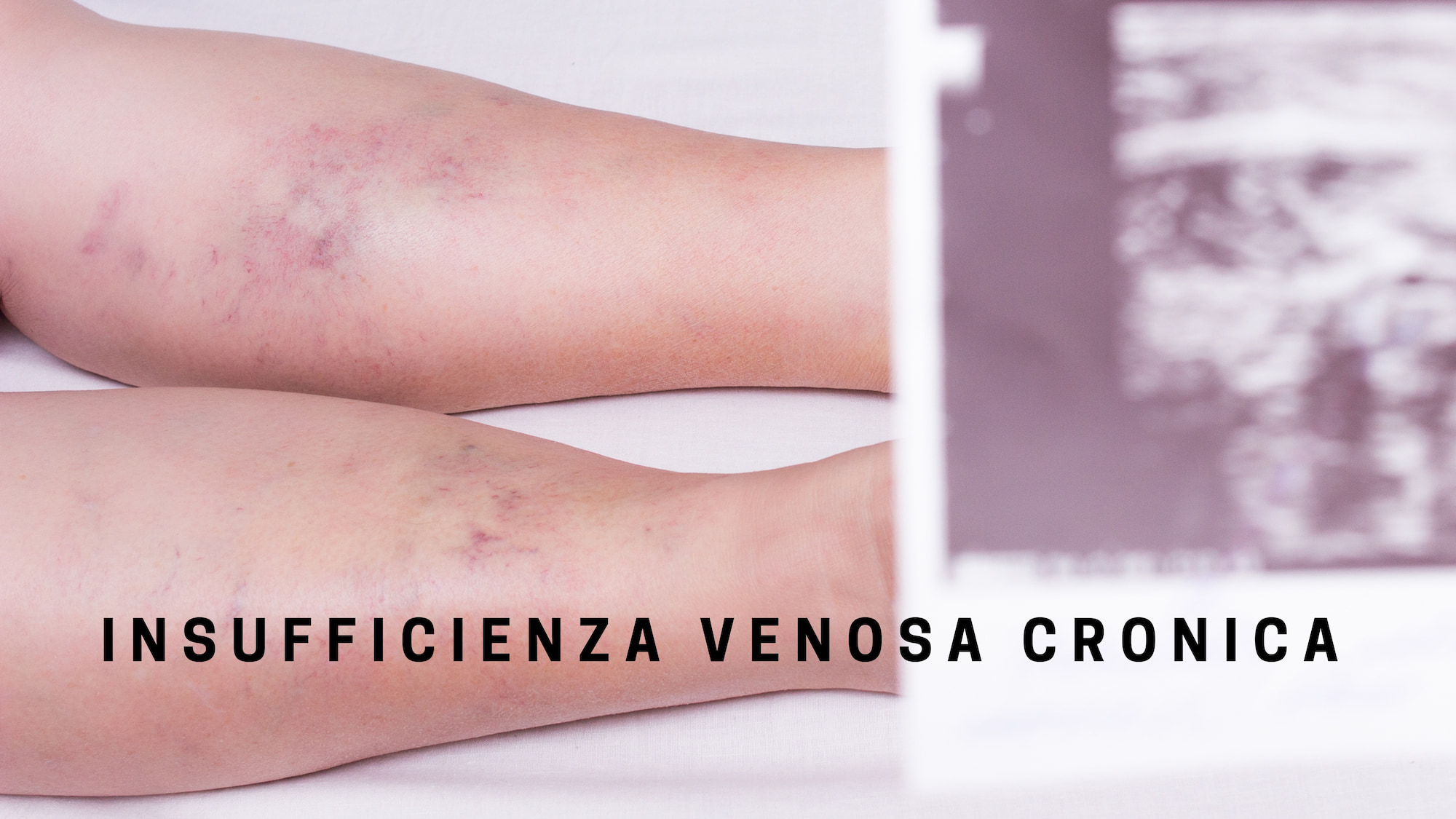 Insufficienza venosa cronica - OmegaPharma