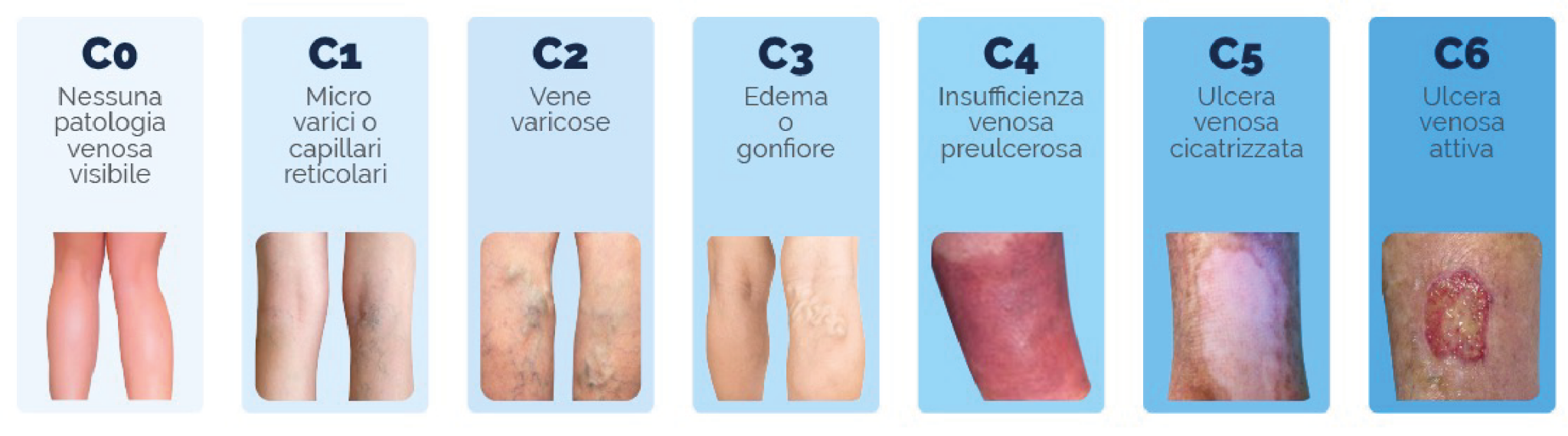 Insufficienza venosa cronica degli arti inferiori: nuovi scenari per ...