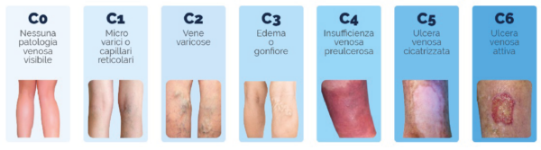 Insufficienza venosa cronica degli arti inferiori: nuovi scenari per ...