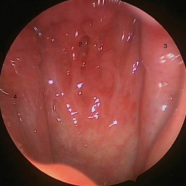 Malattia da reflusso gastroesofagea (MRGE) e Malattia da reflusso ...